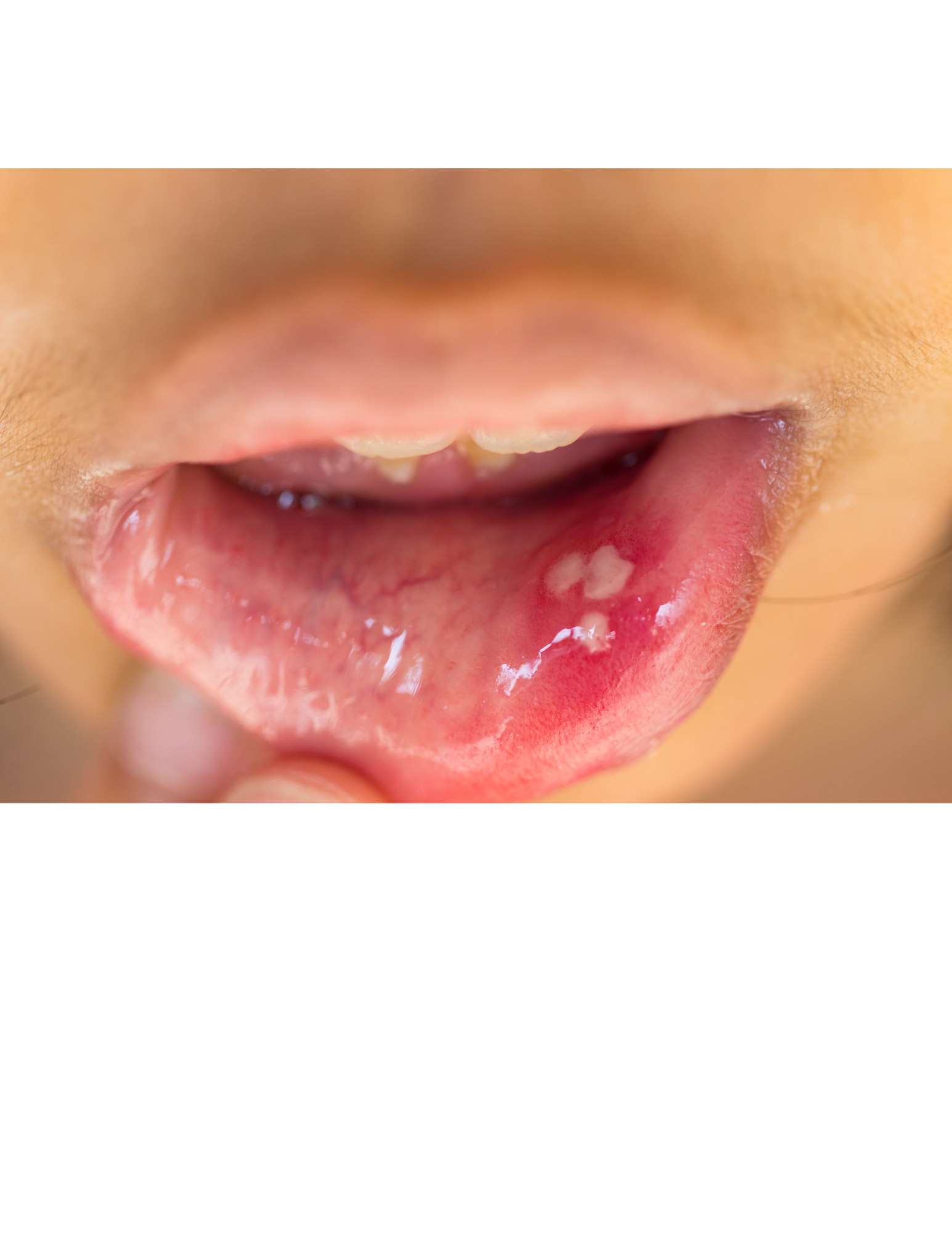 Canker Sores Understanding | Simplified Pharmacy